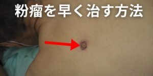 粉瘤を早く治す方法｜最短で治すために知っておくべき正しい対処法 | 東京皮膚のできものと粉瘤クリニック ふるばやし形成外科 新宿院